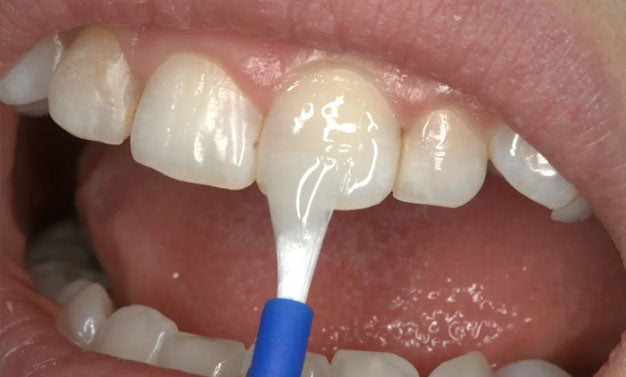 La remineralisation des dents de lait : Un pouvoir naturel méconnu ...